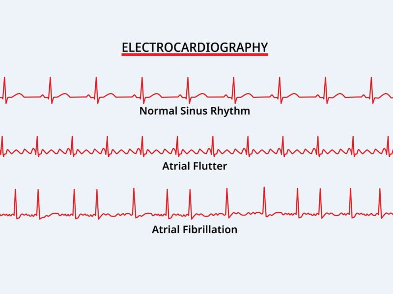 Practice Points for Atrial Fibrillation | Allevia Cardiology Ascot