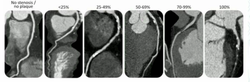 Practice Points for CTCA | News | Allevia Cardiology Ascot